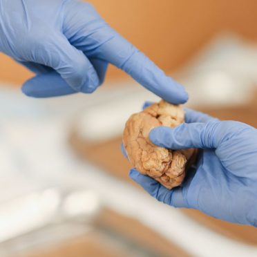 Inside the adult ADHD brain - MIT McGovern Institute